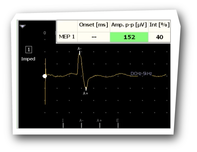 DuoMAG XT TMS System | Brainbox